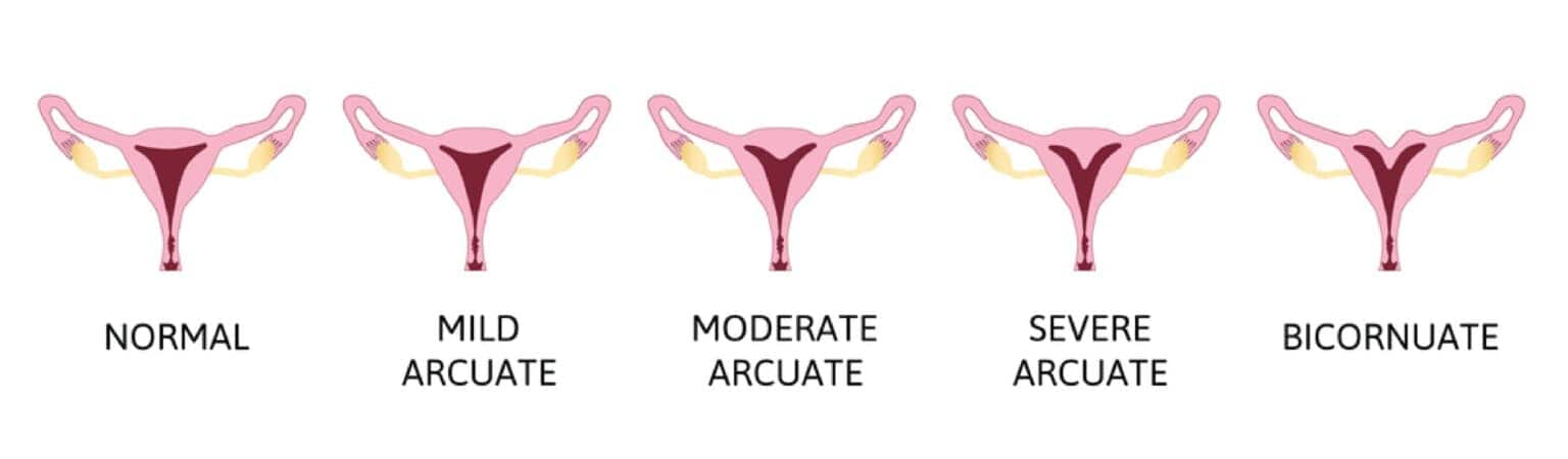 Arcuate Uterus Causes Symptoms And Treatments Birla Fertility And Ivf